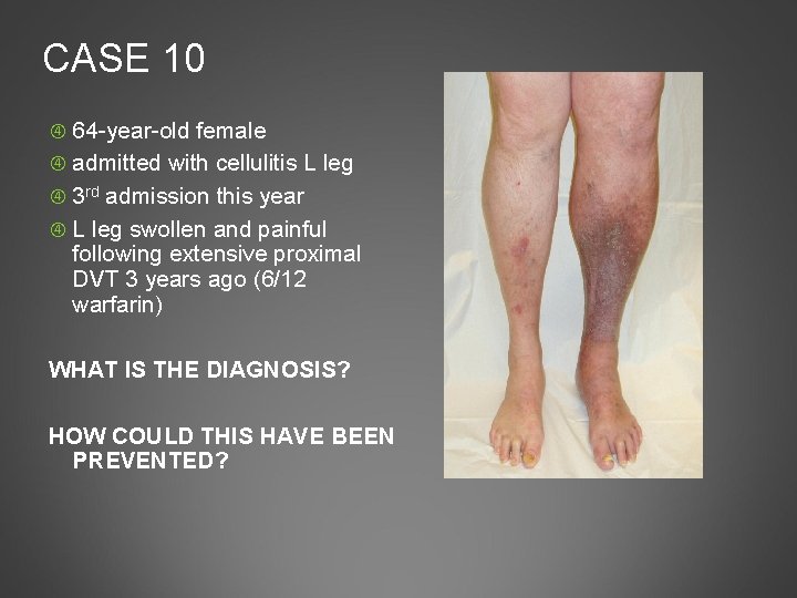 A MASTERCLASS IN VENOUS THROMBOEMBOLISM VTE Dr Tom