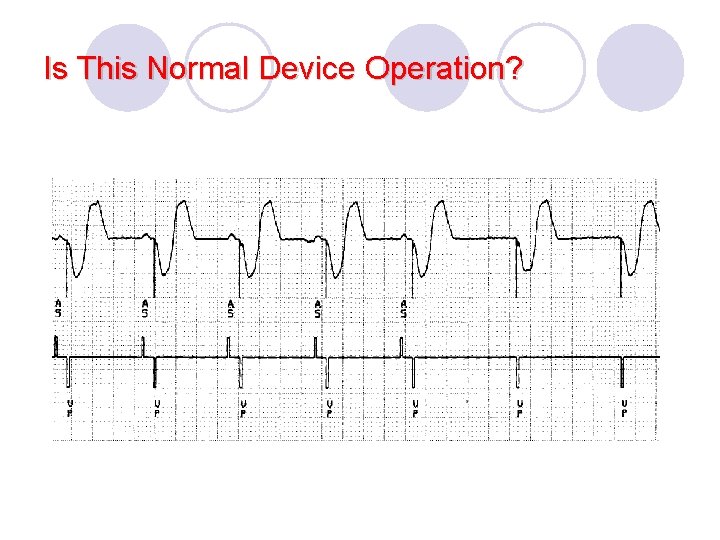 Cardiac Implantable Devices Nursing Care The Basics and