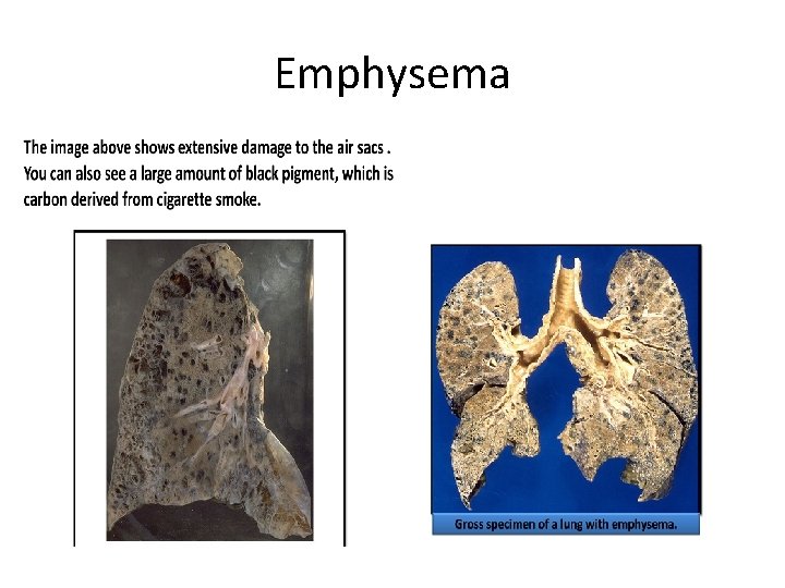 Chronic Obstructive Pulmonary Disease also known as chronic