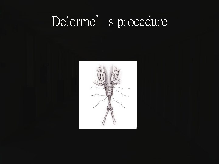 Abdominal approach for Rectal prolapse Leung Yu Wing