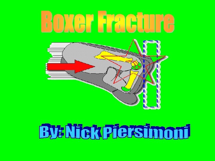 A boxer fracture is a break in the