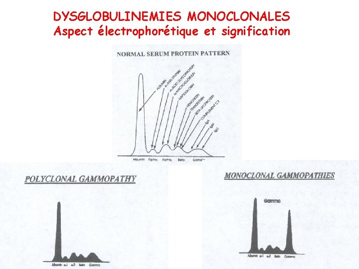 DYSGLOBULINEMIES MONOCLONALES ANOMALIES BIOLOGIQUES SERIQUES ...