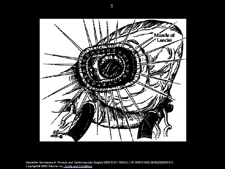 The Rastelli Operation Carl Lewis Backer Constantine Mavroudis