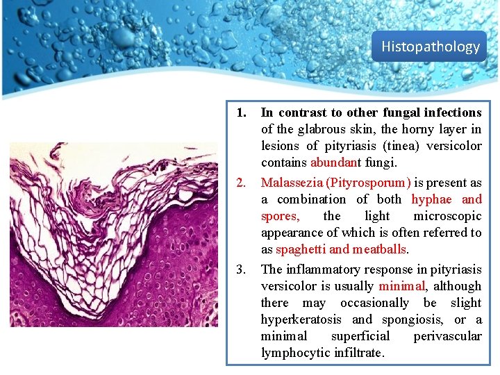 DERMATOPHYTOSIS 23 Fungal Diseases Histopathology 1 2 3