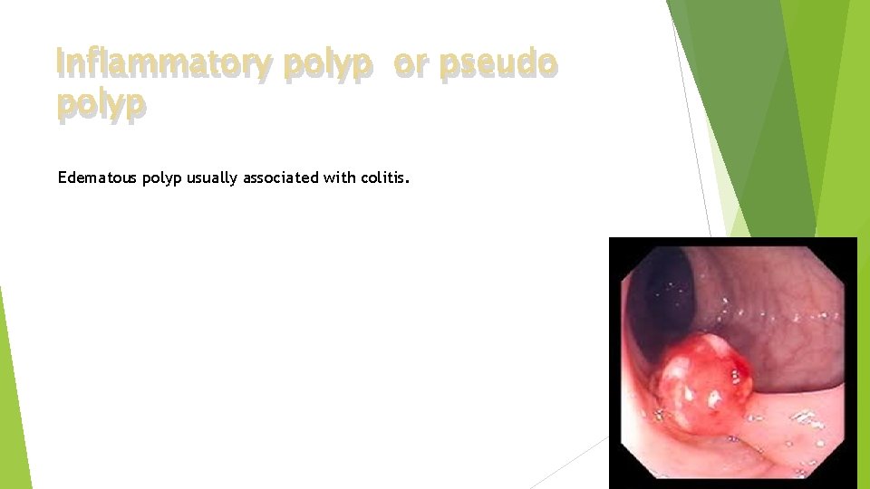 Rectum lecture 2 Partial Rectal prolapseMucosal The mucous
