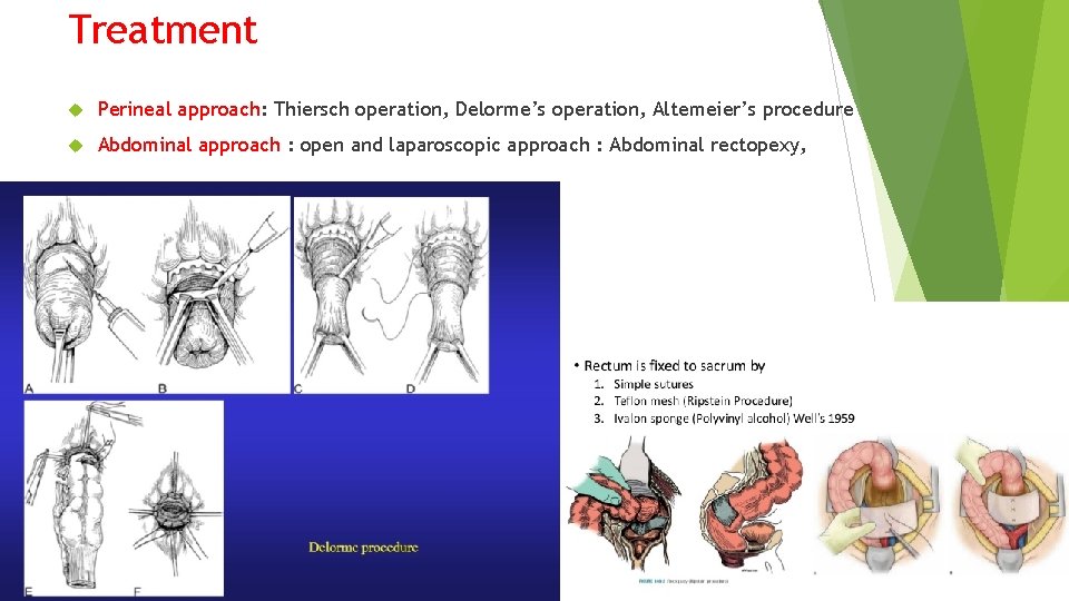 Rectum lecture 2 Partial Rectal prolapseMucosal The mucous