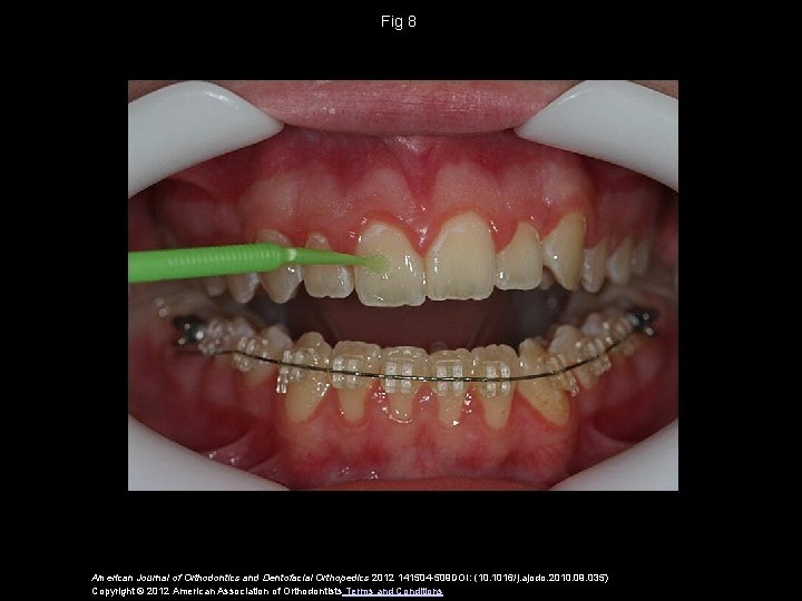 Modified bonding technique for a standardized and effective