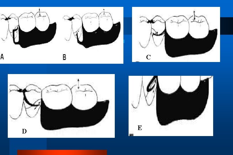 Principles of RPD Design Dr Rola Shadid Differentiation