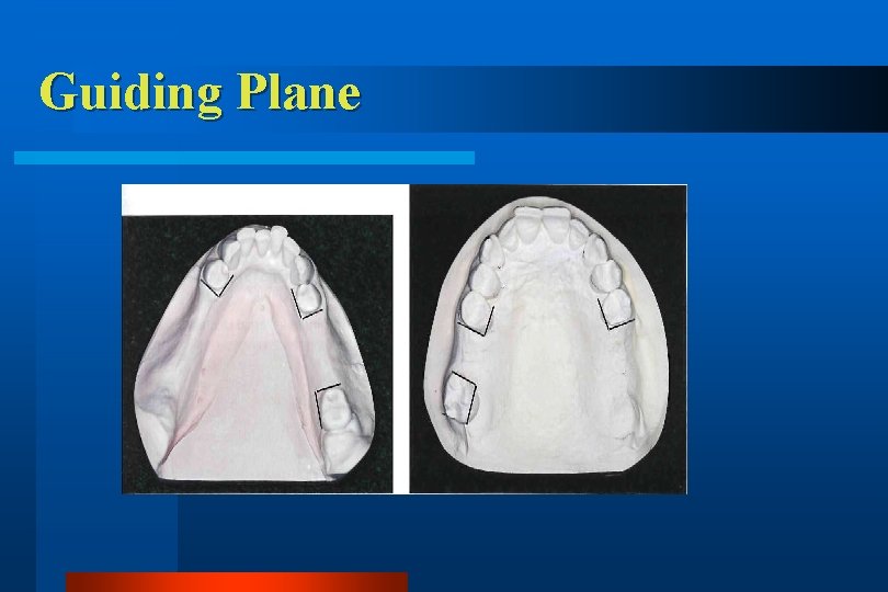 Principles of RPD Design Dr Rola Shadid Differentiation