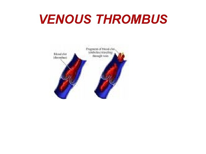 THROMBOSIS DEFINITION PROCESS OF FORMATION OF SOLID MASS