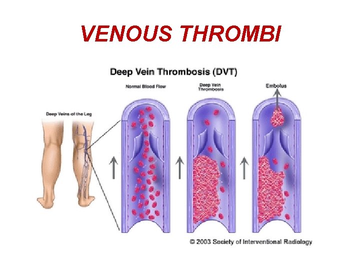 THROMBOSIS DEFINITION PROCESS OF FORMATION OF SOLID MASS