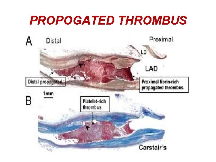 THROMBOSIS DEFINITION PROCESS OF FORMATION OF SOLID MASS