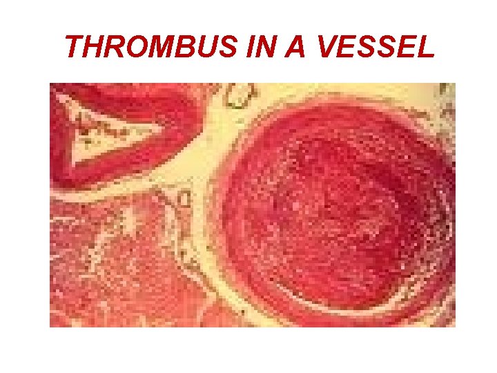 THROMBOSIS DEFINITION PROCESS OF FORMATION OF SOLID MASS