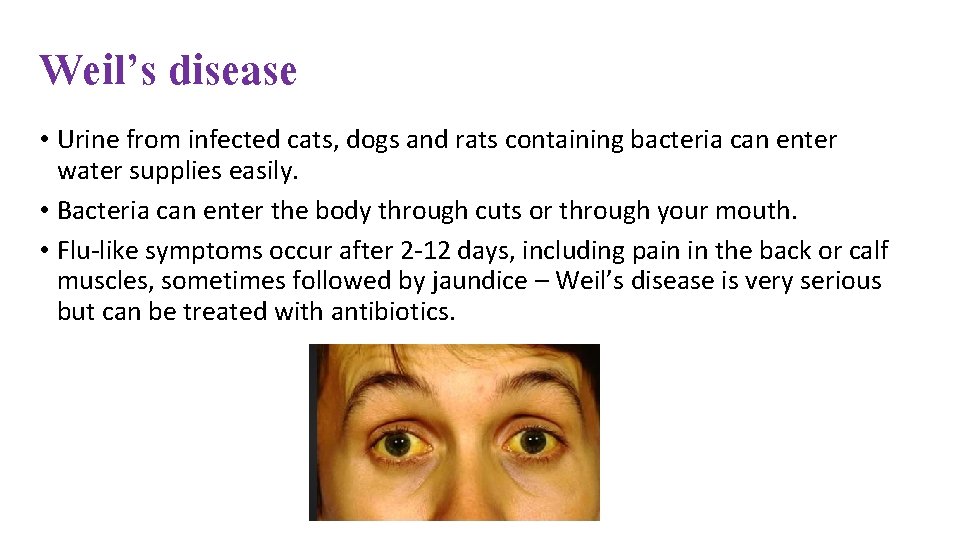 10 Stings bites ticks Weils disease s e