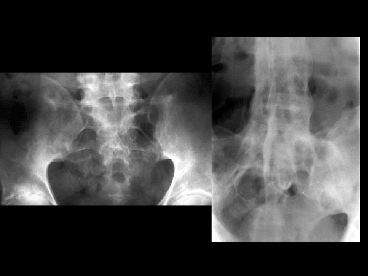 Aneurysmal Bone Cyst Findings expansile lytic lesion of