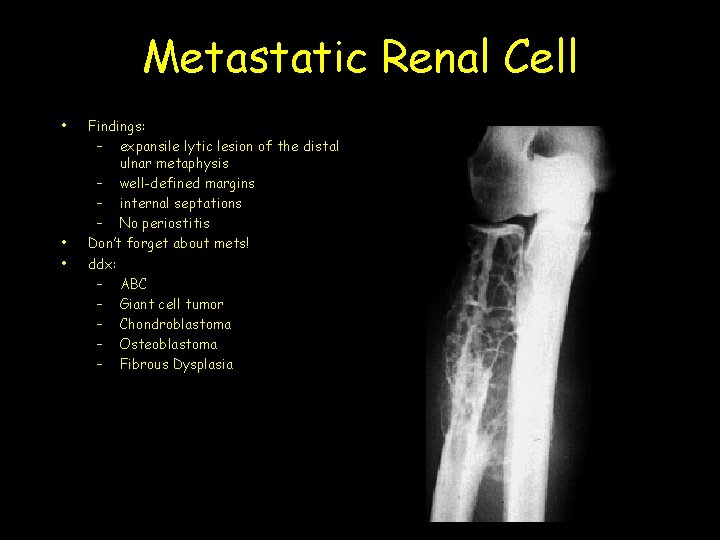 Aneurysmal Bone Cyst Findings expansile lytic lesion of