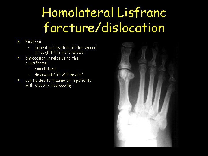 Aneurysmal Bone Cyst Findings expansile lytic lesion of