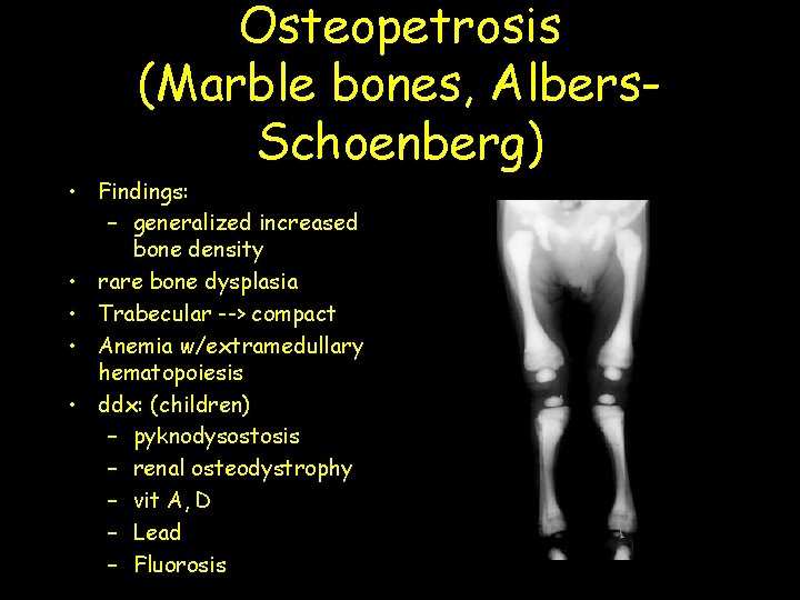 Aneurysmal Bone Cyst Findings expansile lytic lesion of