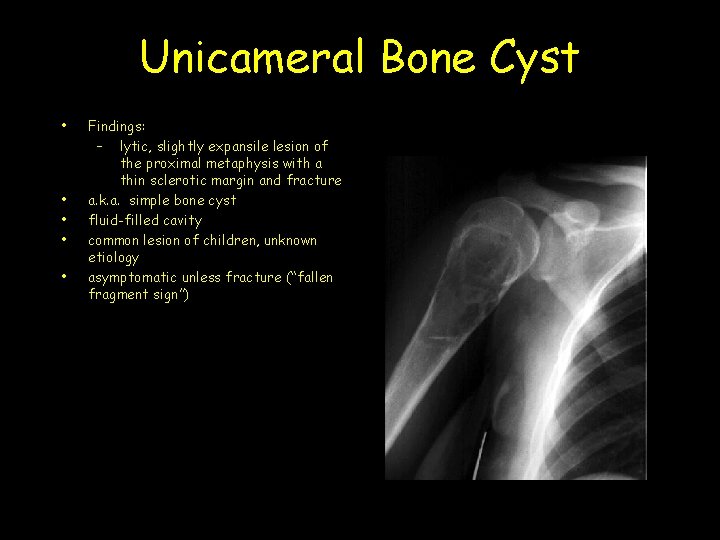 Aneurysmal Bone Cyst Findings expansile lytic lesion of