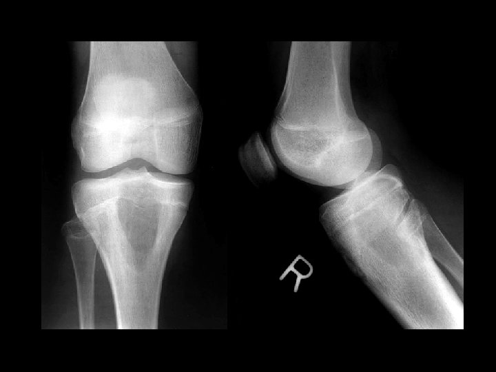 Aneurysmal Bone Cyst Findings expansile lytic lesion of