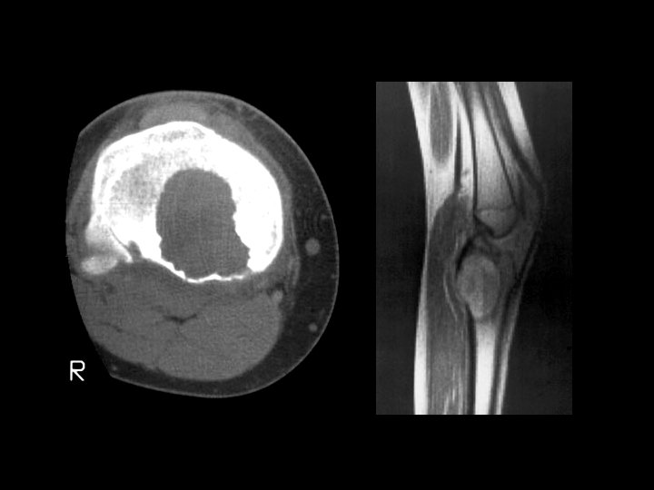 Aneurysmal Bone Cyst Findings expansile lytic lesion of