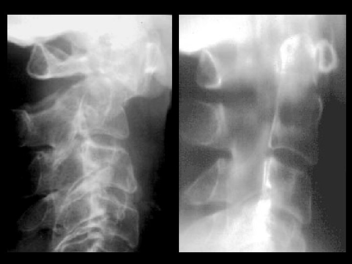 Aneurysmal Bone Cyst Findings expansile lytic lesion of