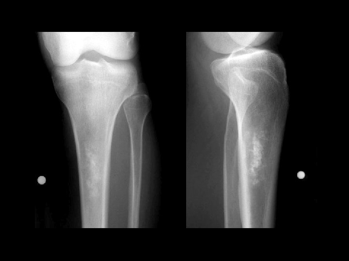 Aneurysmal Bone Cyst Findings expansile lytic lesion of