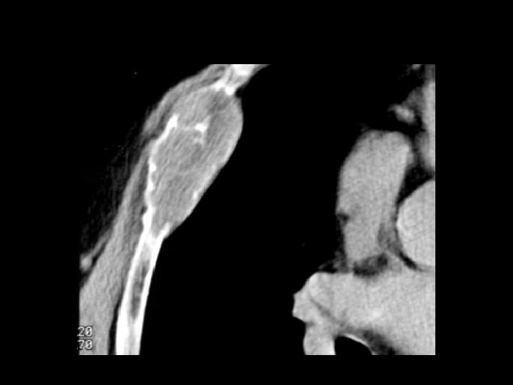 Aneurysmal Bone Cyst Findings expansile lytic lesion of