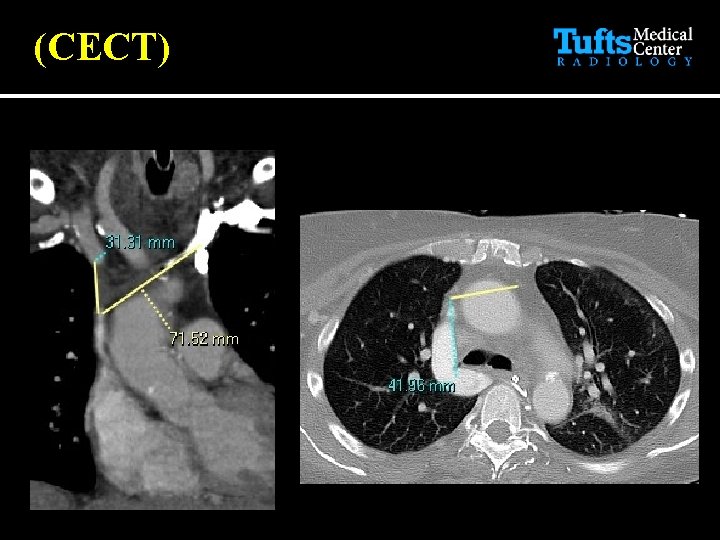RadiofrequencyAssisted Recanalization in a Patient with SVC Syndrome