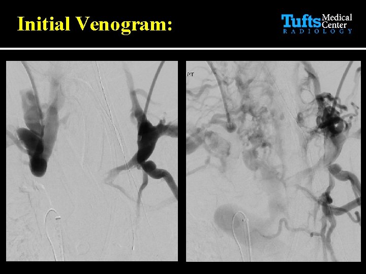 RadiofrequencyAssisted Recanalization in a Patient with SVC Syndrome