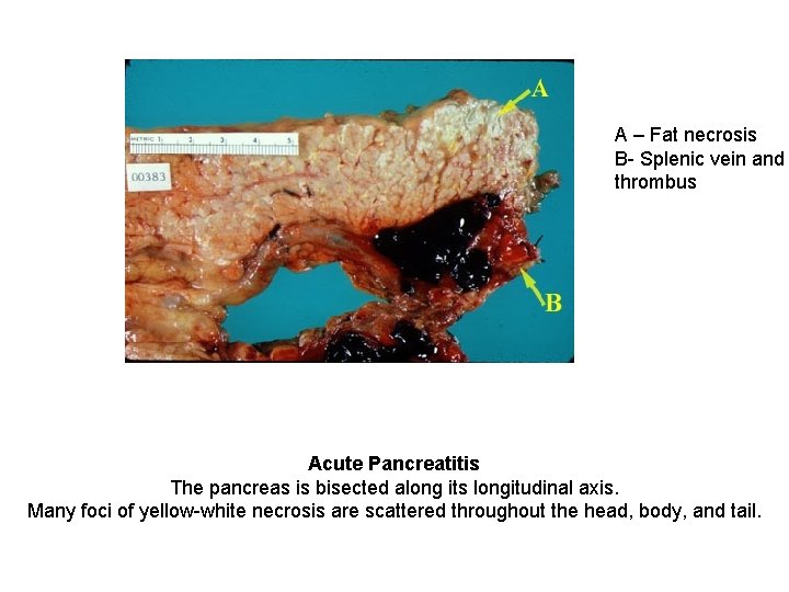 Pancreas Pathology Lab Case 2 47 yearold alcoholic
