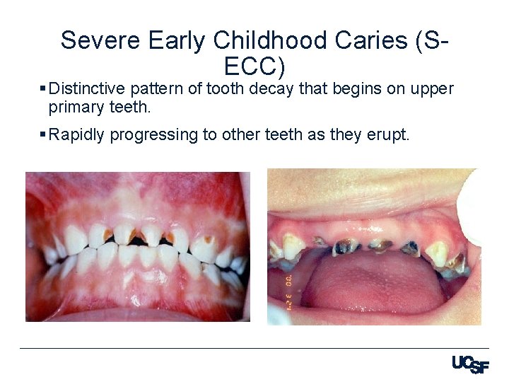Caries Risk Assessment and Disease Prevention Thuan Le