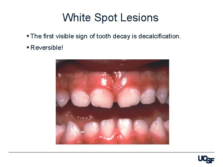 Caries Risk Assessment and Disease Prevention Thuan Le