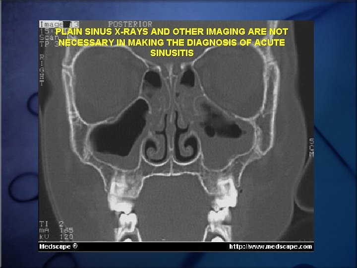 Management of Acute and Chronic Sinusitis Presentation Outline