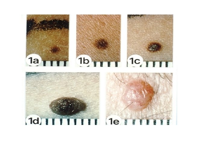 MELANOCYTES AND MELANOSOMES MELANOCYTES ARE THE CELLS THAT