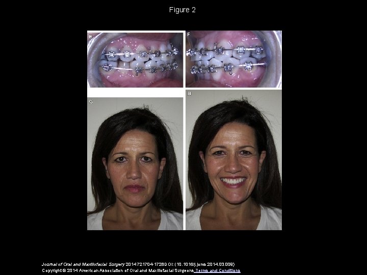 Low Condylectomy and Orthognathic Surgery to Treat Mandibular