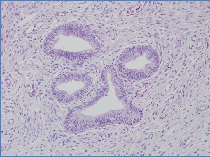 Cytology Hyperchromatic enlarged pleomorphic nucleus High NC ratio