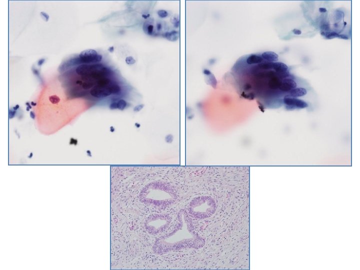 Cytology Hyperchromatic enlarged pleomorphic nucleus High NC ratio