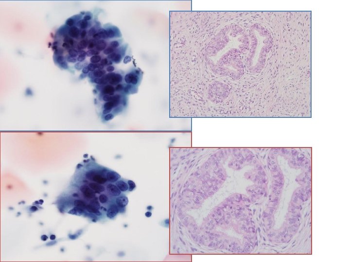 Cytology Hyperchromatic enlarged pleomorphic nucleus High NC ratio