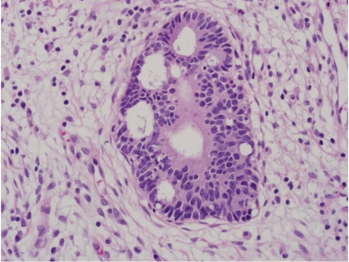 Cytology Hyperchromatic enlarged pleomorphic nucleus High NC ratio