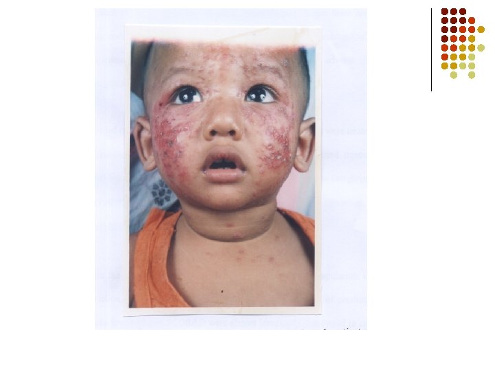 Topic Efficacy of topical tacrolimus in atopic dermatitis