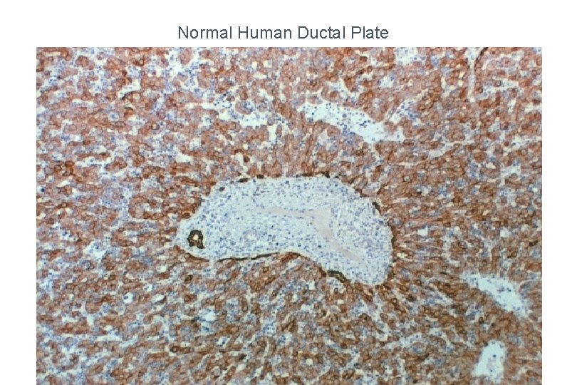 The Liver Disease of ARPKD Congenital Hepatic Fibrosis