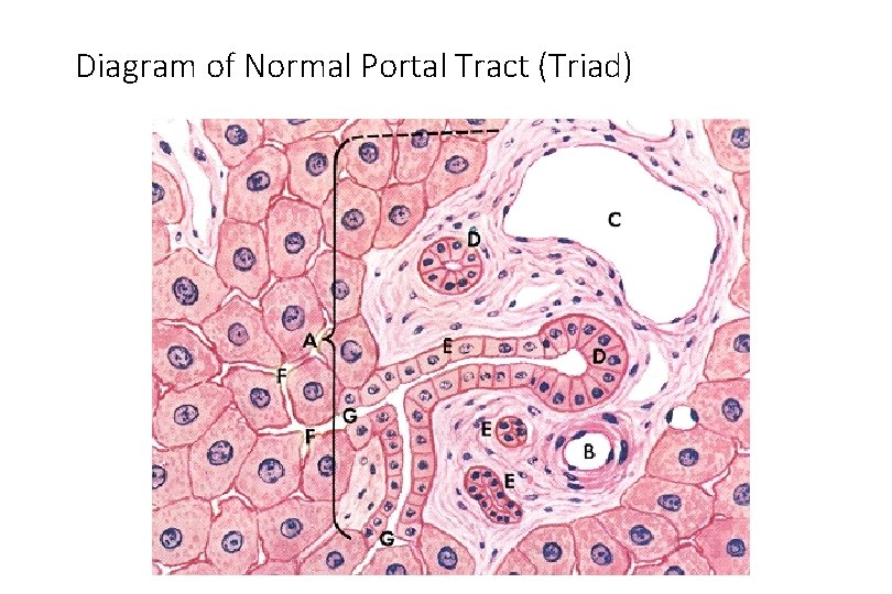 The Liver Disease of ARPKD Congenital Hepatic Fibrosis