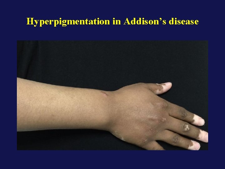 ADRENAL DISORDERS Introduction Dr Atallah AlRuhaily Consultant ...