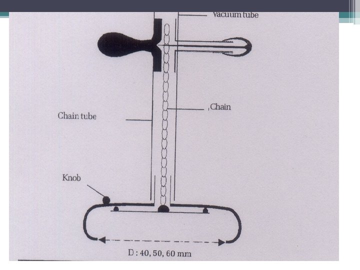 Vacuum Extraction The Ventouse Definition It is an