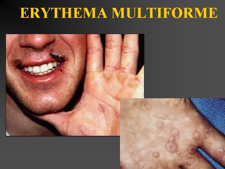 DERMATOLOGY DESQUAMATION OF THE SKIN ERYTHEMA MULTIFORME Iris