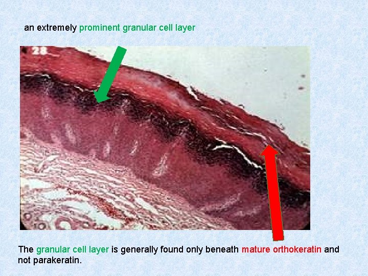FocalfrictionalBenign keratosis A white lesion that is related