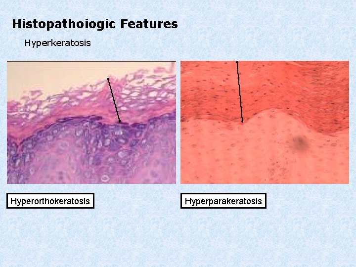 FocalfrictionalBenign keratosis A white lesion that is related