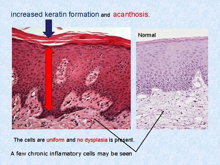 FocalfrictionalBenign keratosis A white lesion that is related