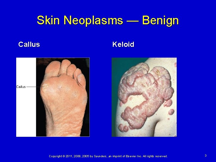 Chapter 16 Lesson 16 3 acne burns cellulitis